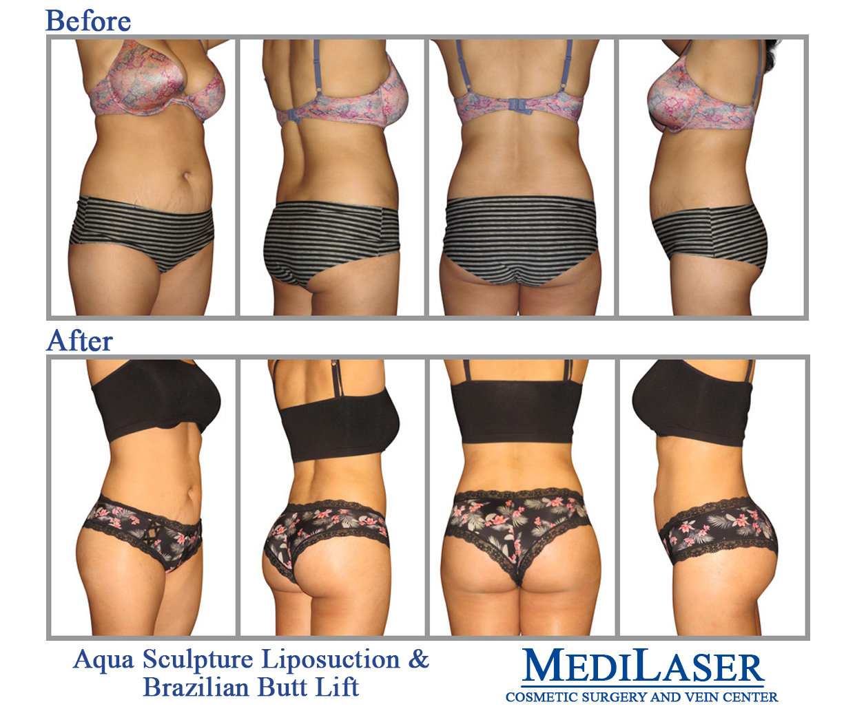 BBL Before & After | Medilaser | Frisco, TX