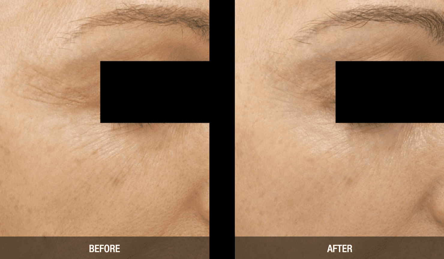 Exceed ™ Microneedling - Colbert Institute of Anti Aging