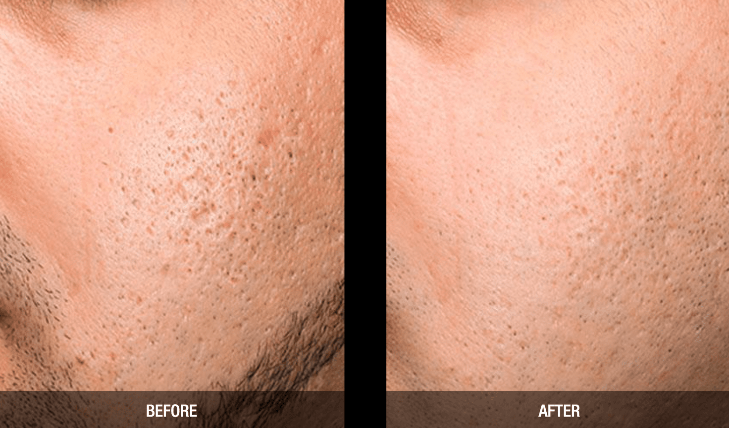 Exceed ™ Microneedling - Colbert Institute of Anti Aging