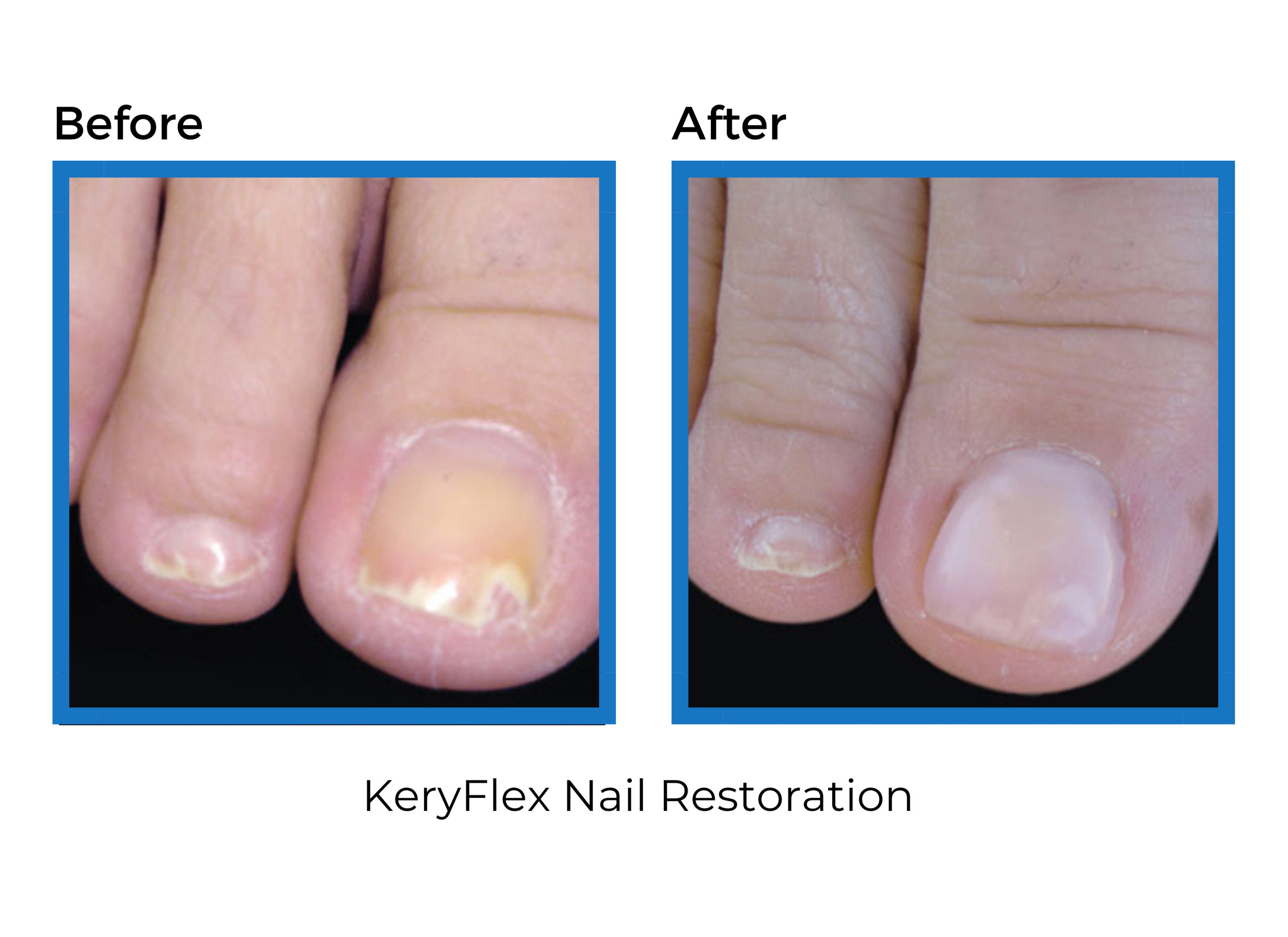 KeryFlex™ Nail Restoration System - Foot & Ankle Centers of Frisco and ...