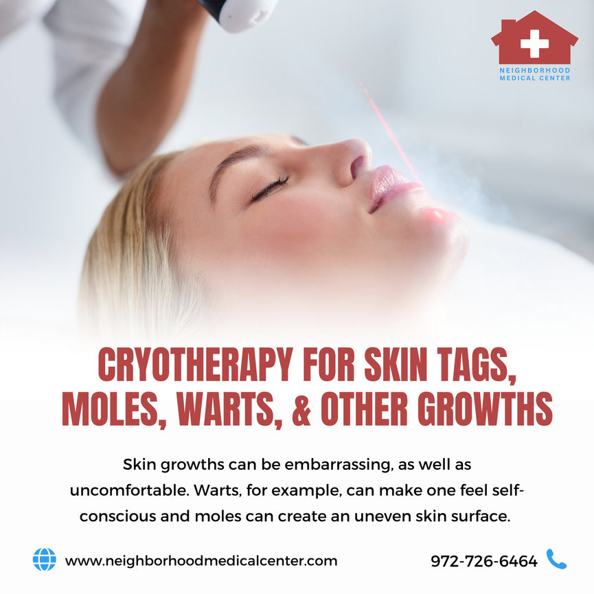 Cryotherapy for Skin Tags, Moles, Warts, & Other Growths in Dallas ...