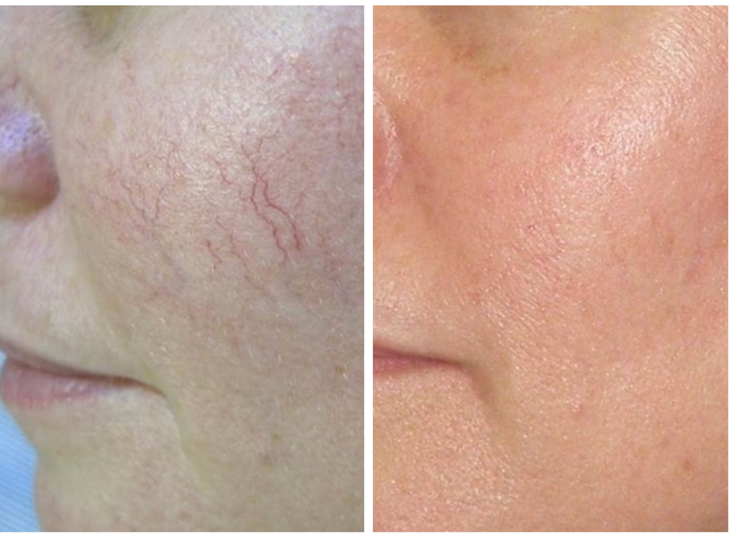 IPL Laser Facial - Feel Ideal 360 Med Spa - Southlake, TX